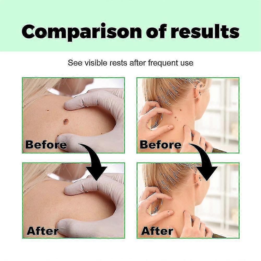 3*125g Smooth Skin Wart Eliminator Soap Natural Aloe Vera Soap,instant ...