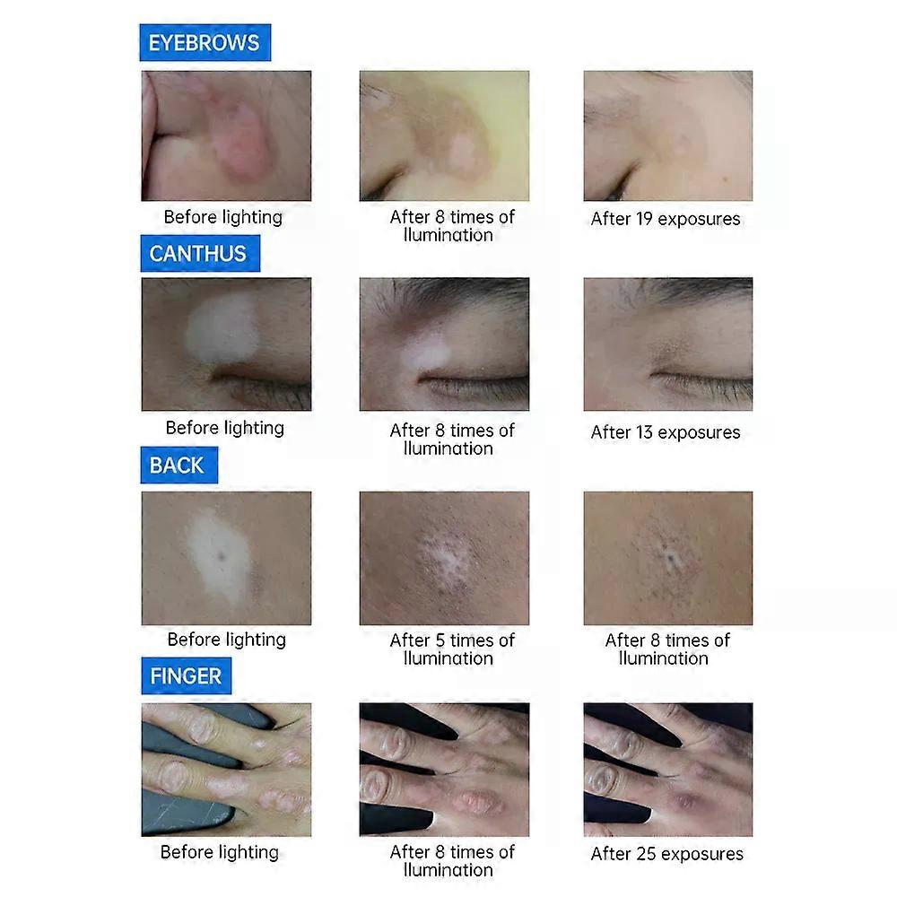 UV 311nm Ultraviolet Phototherapy Device Uses Philips Lamp UVB To Treat ...