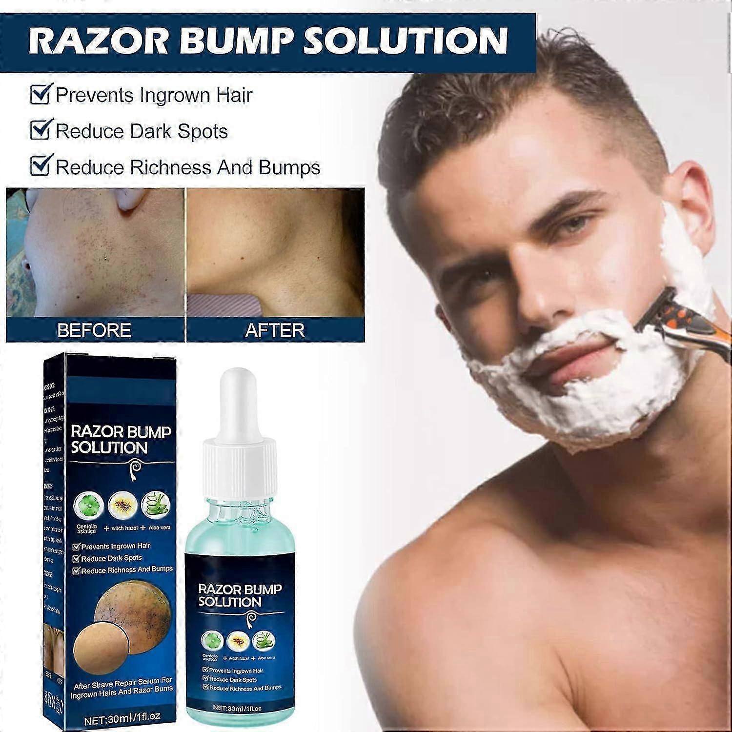 Razor Bumps Solution for Women and Men, Ingrown Hair Treatment, Razor ...