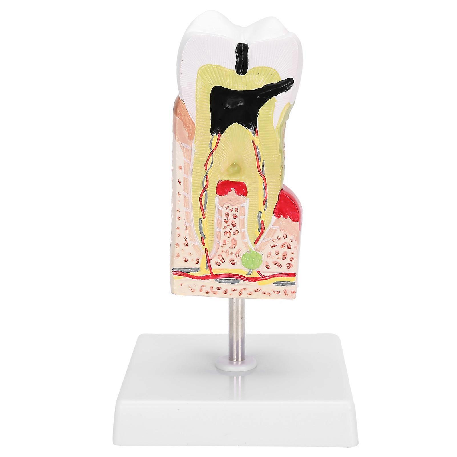 Dental Caries Tooth Model Dental Teeth Model for Teaching Training ...