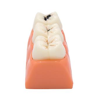 Tooth Decay Model Tooth Lesions Four Times Teeth Comprehensive ...