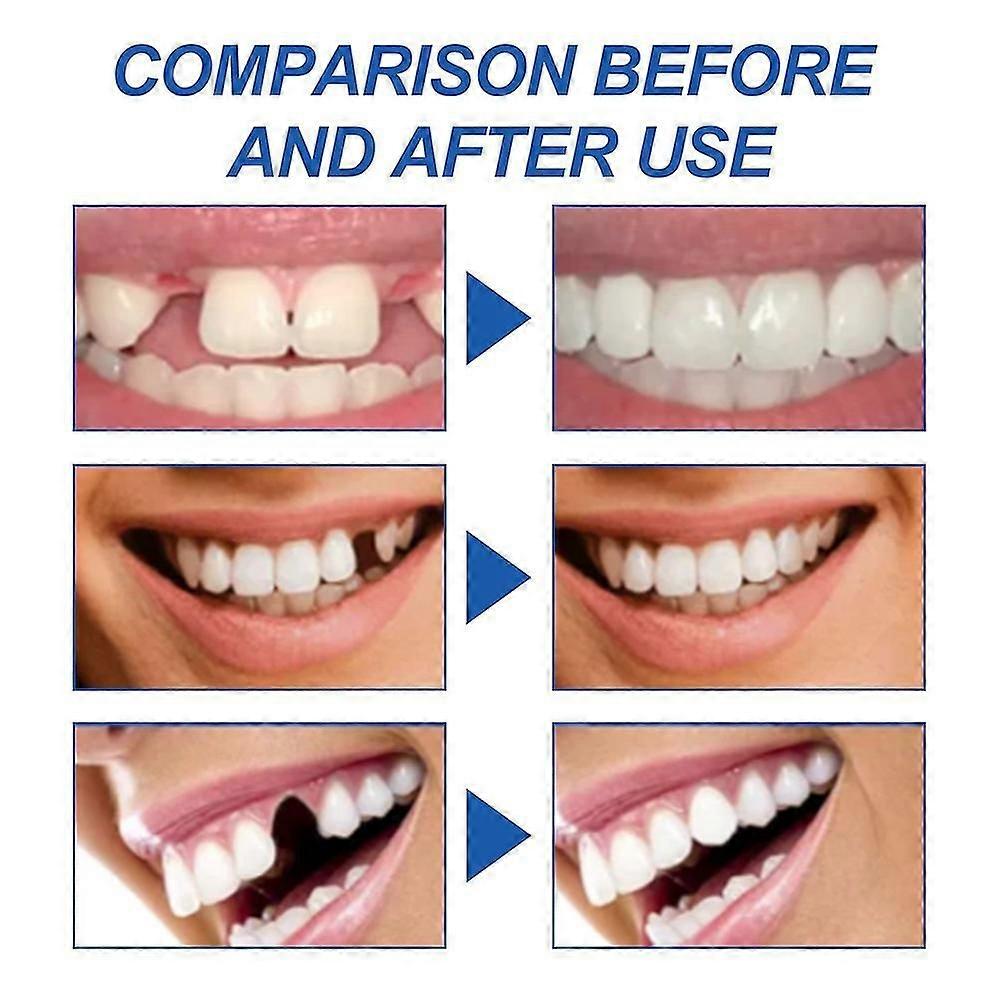 Permanent Tooth Filling Cement DIY Dental Repair Kit for Cavities ...